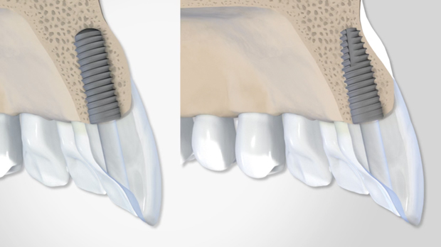 Understand Types of Implants and Indications for Each | Spear Education
