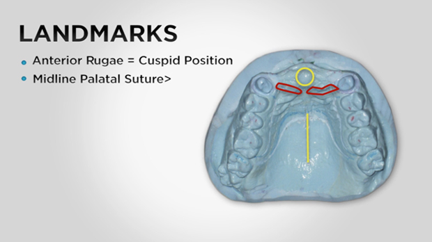 Setting Teeth for Our Edentulous Patients | Spear Education