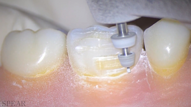 Posterior Crowns: Traditional Prep | Spear Education